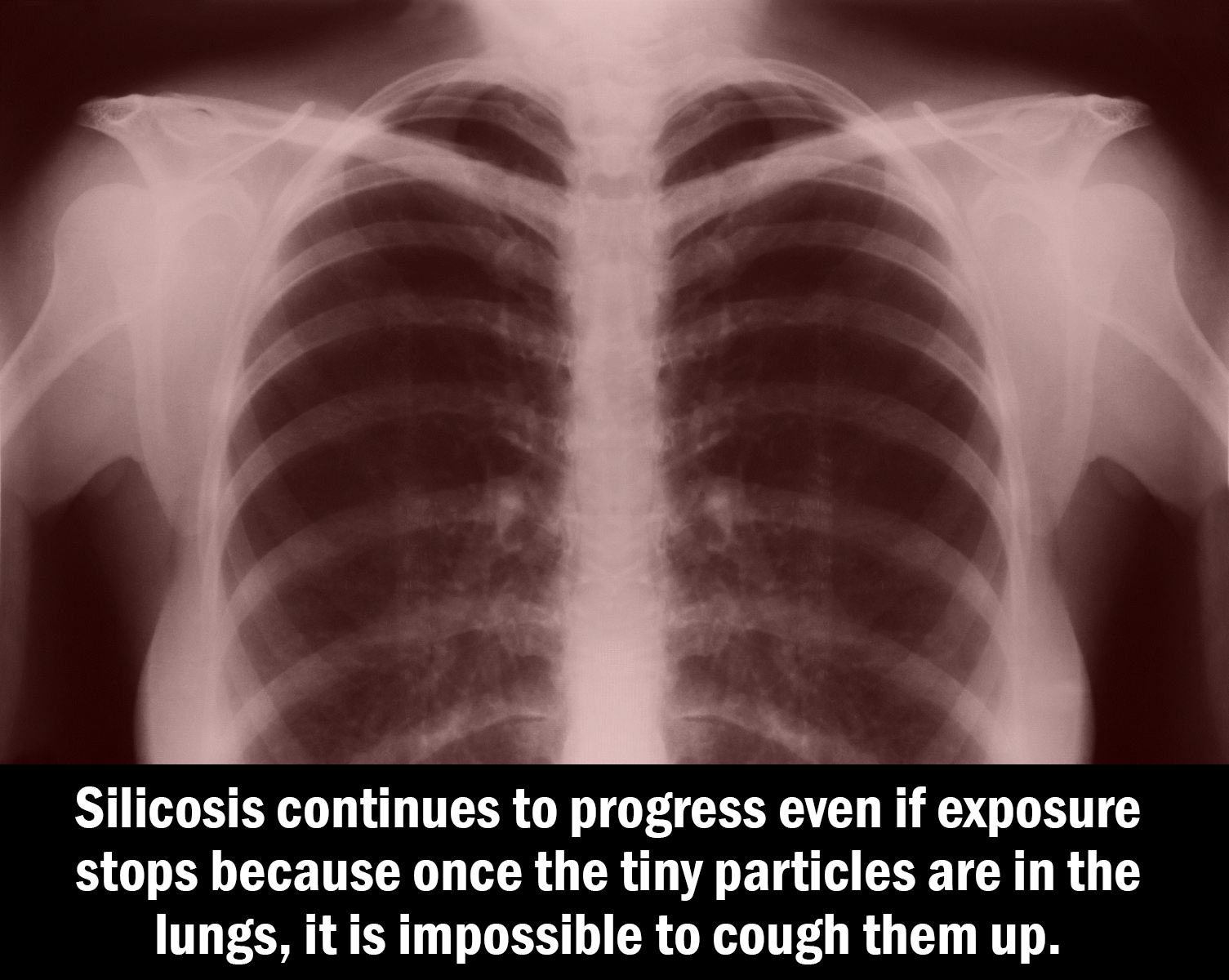 Silicosis Lung